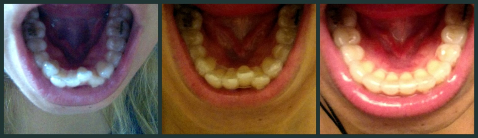 The Truth About Traveling With Invisalign